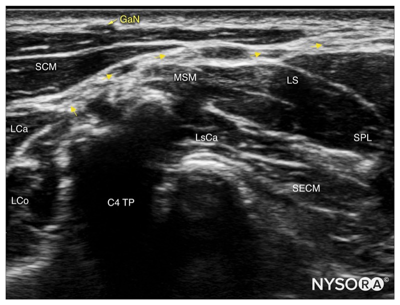 The greater auricular nerve can be commonly seen over the SCM as a ...