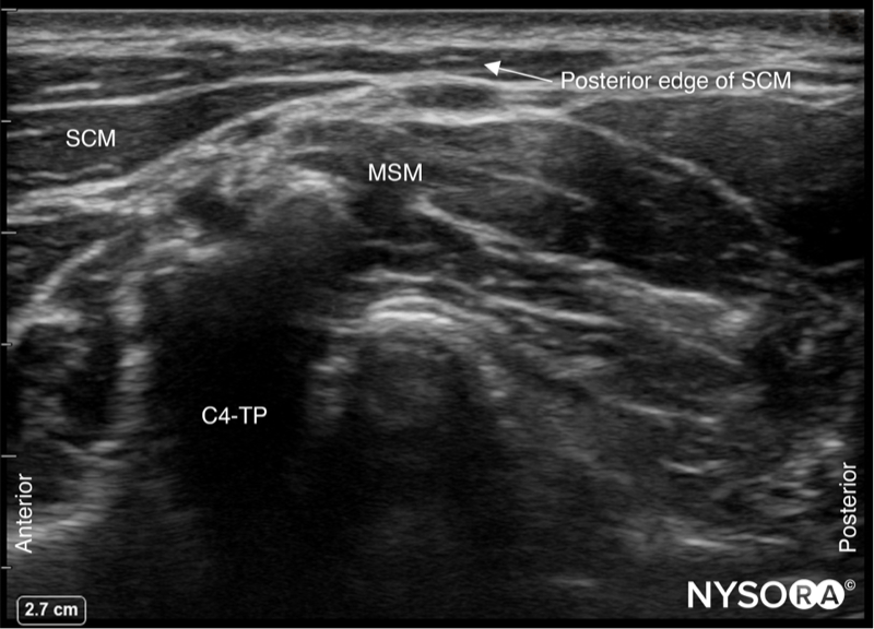 SCM, sternocleidomastoid muscle; MSM, middle scalene muscle; C4-TP ...