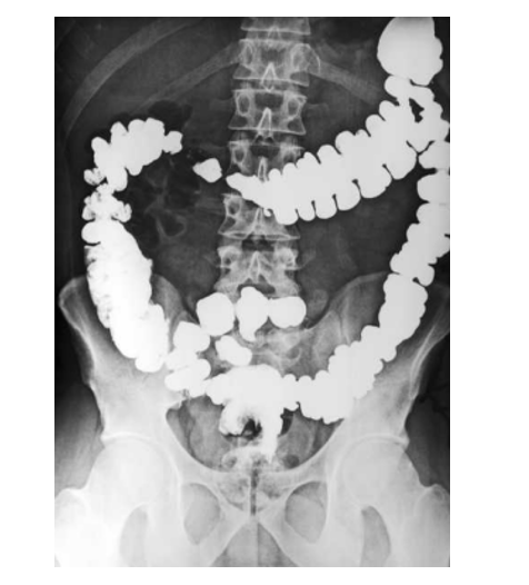 Figure 19. A radiograph (x-ray) of the abdomen using a contrast medium.